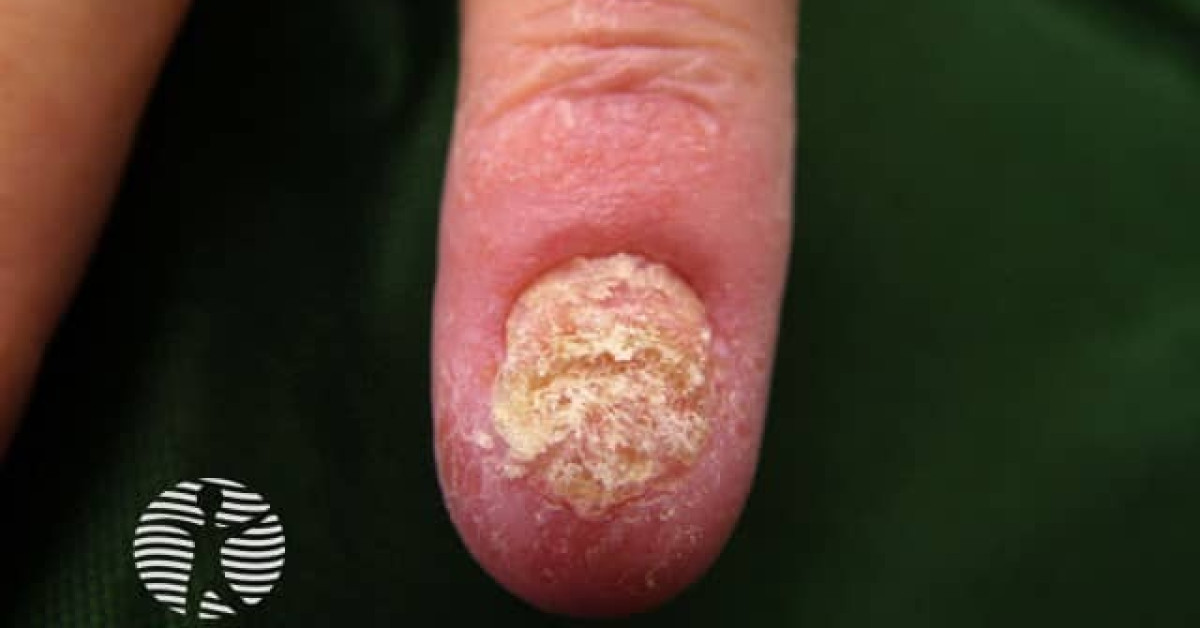 Candida albicans affecting the nails image