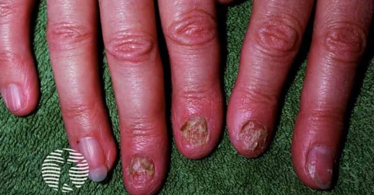 Candida albicans affecting the nails image