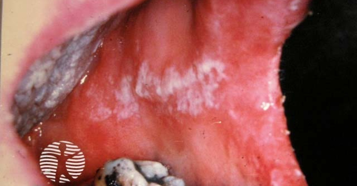 Oral candidiasis image