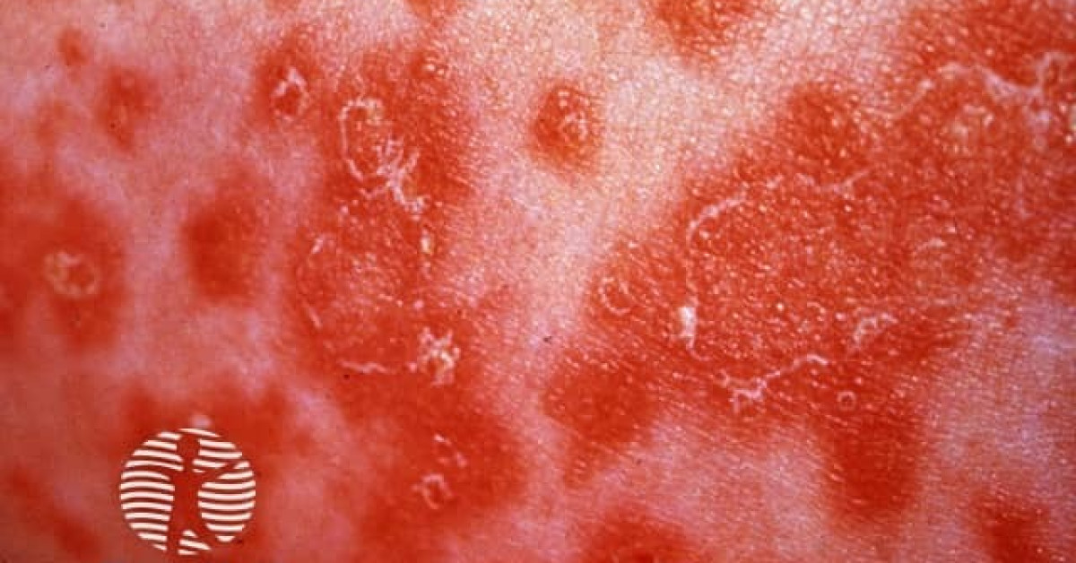 Candida infection image