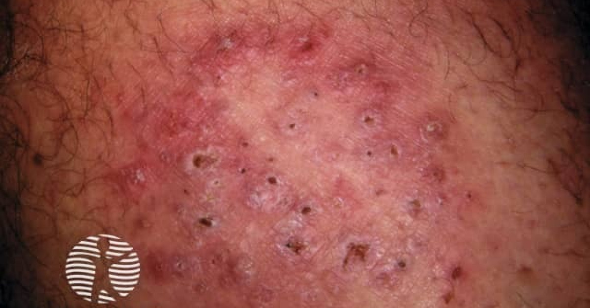 Majocchi granuloma image
