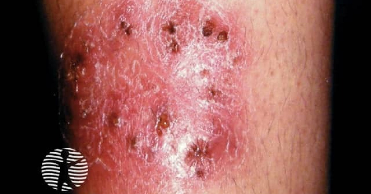 Majocchi granuloma image