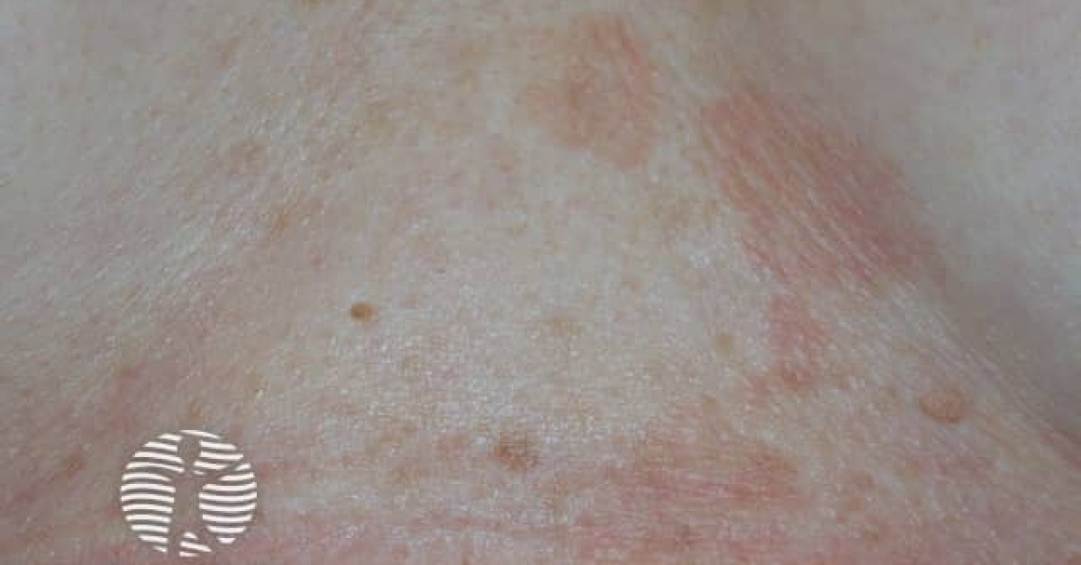 Pityriasis versicolor image