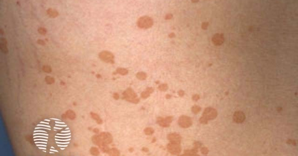 Pityriasis versicolor image