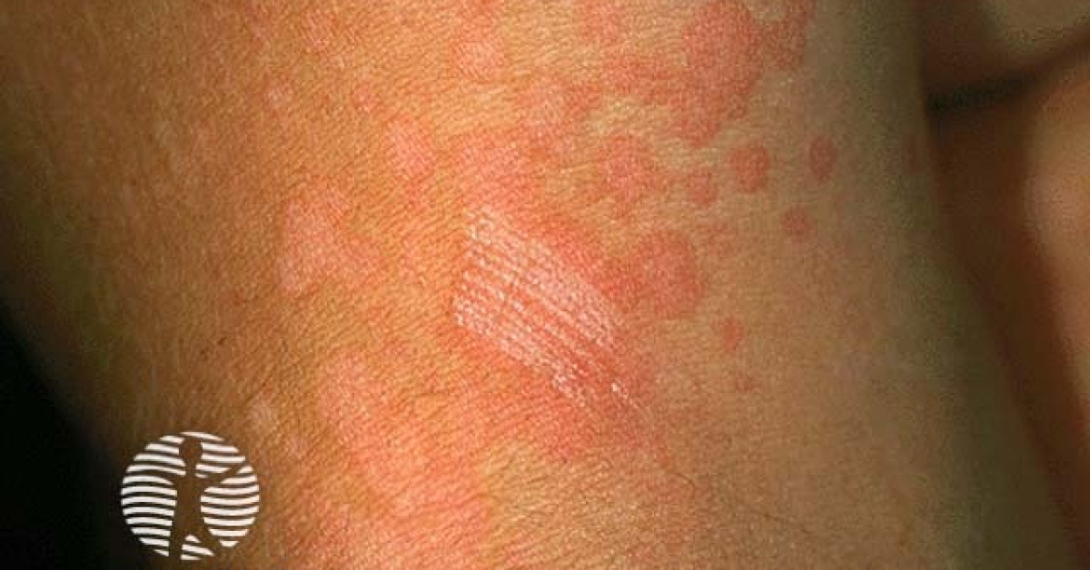 Pityriasis versicolor image