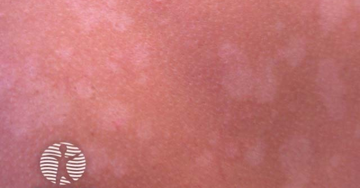 Pityriasis versicolor image