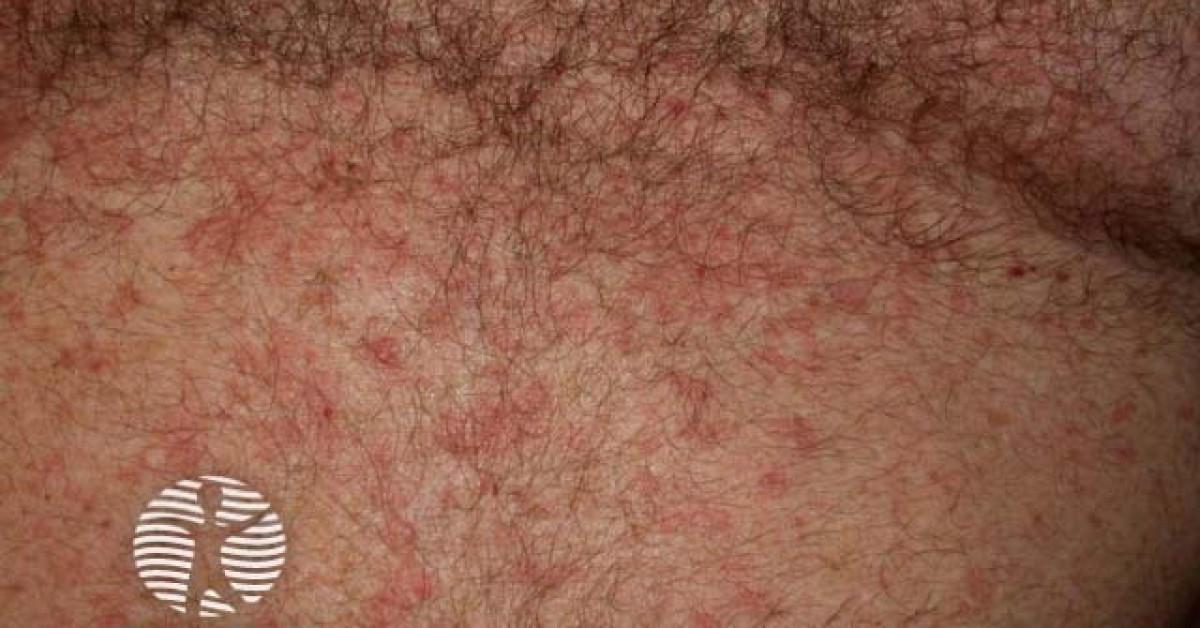 Pityriasis versicolor image