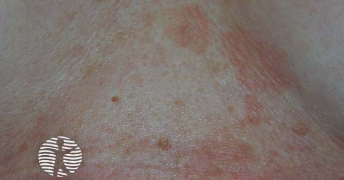 Pityriasis versicolor image
