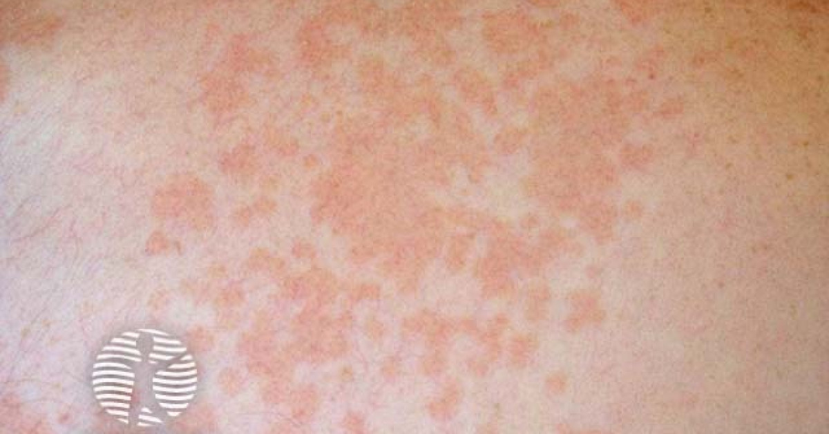 Pityriasis versicolor image