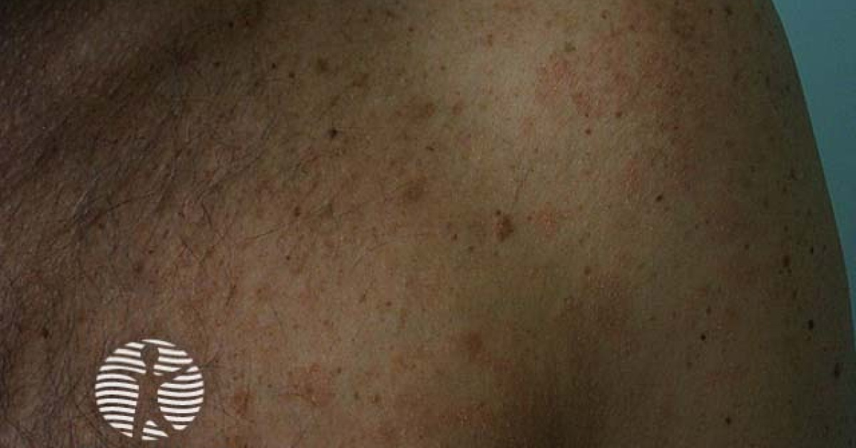 Pityriasis versicolor image