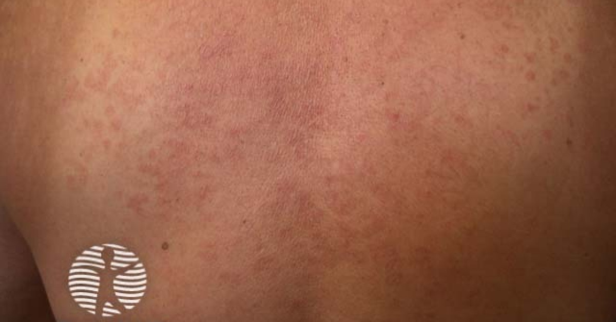 Pityriasis versicolor image
