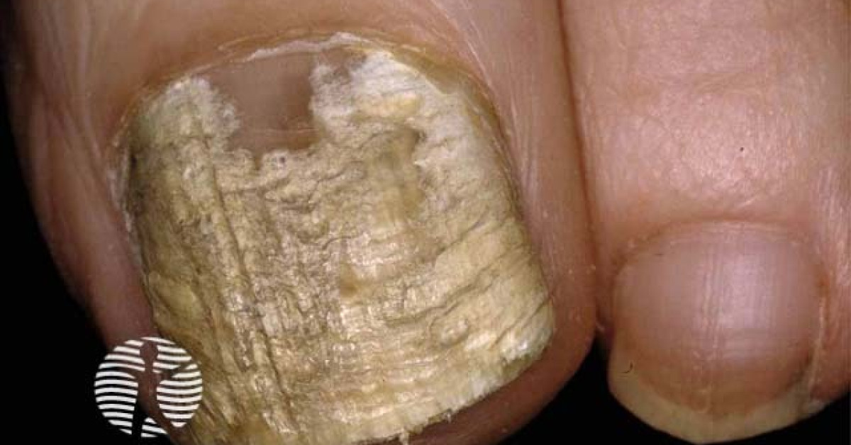 Fusarium infection image