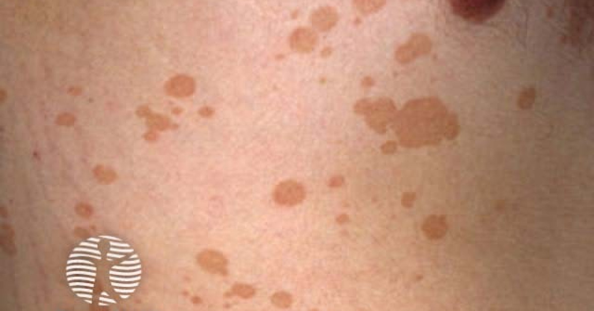 Pityriasis versicolor image