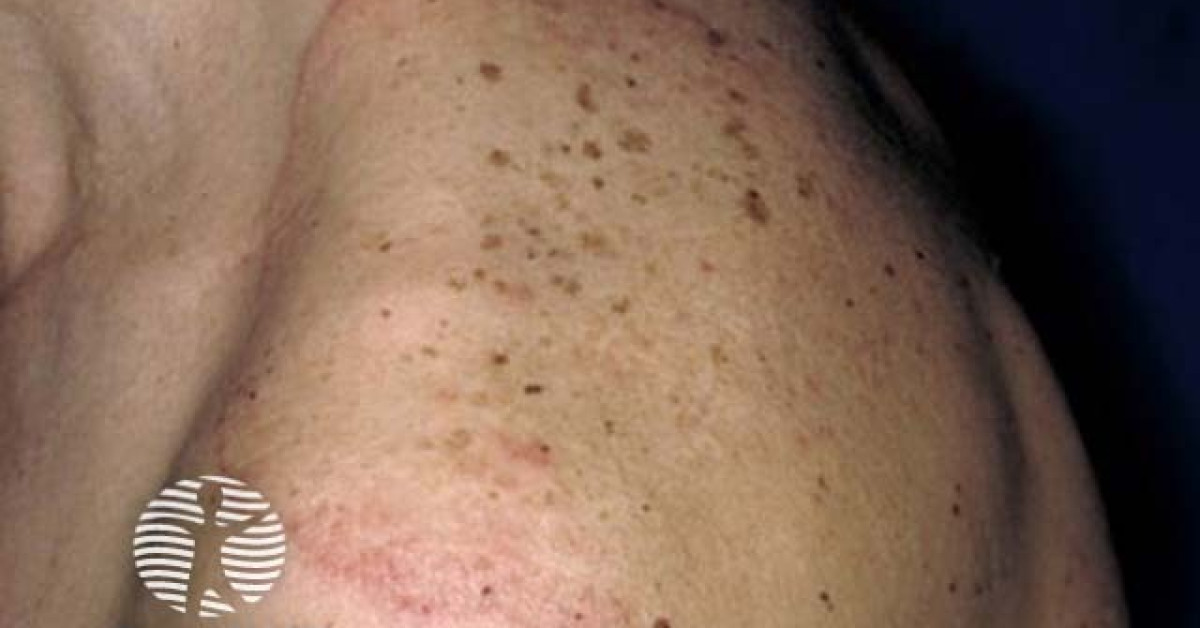 Tinea corporis image