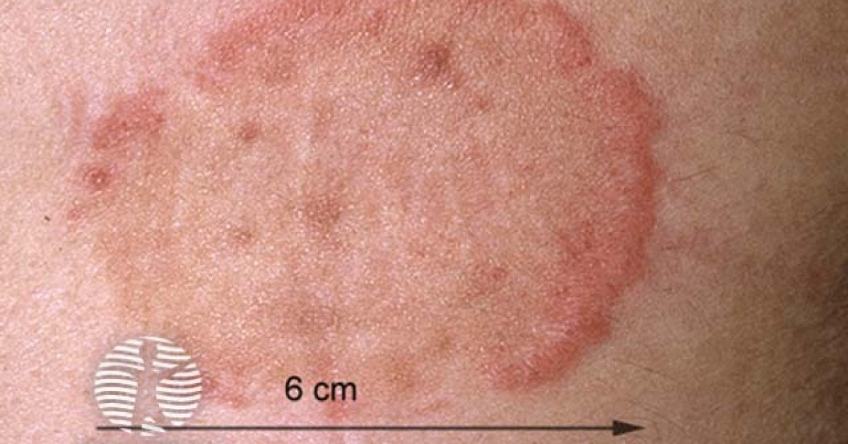 Tinea corporis image