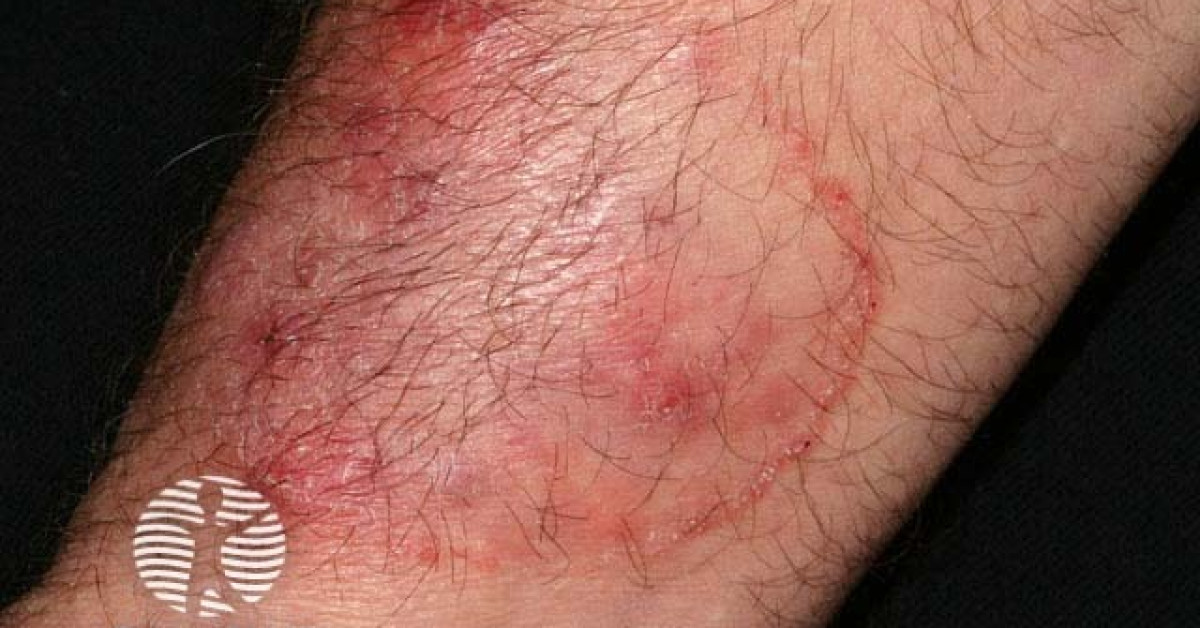 Tinea corporis image
