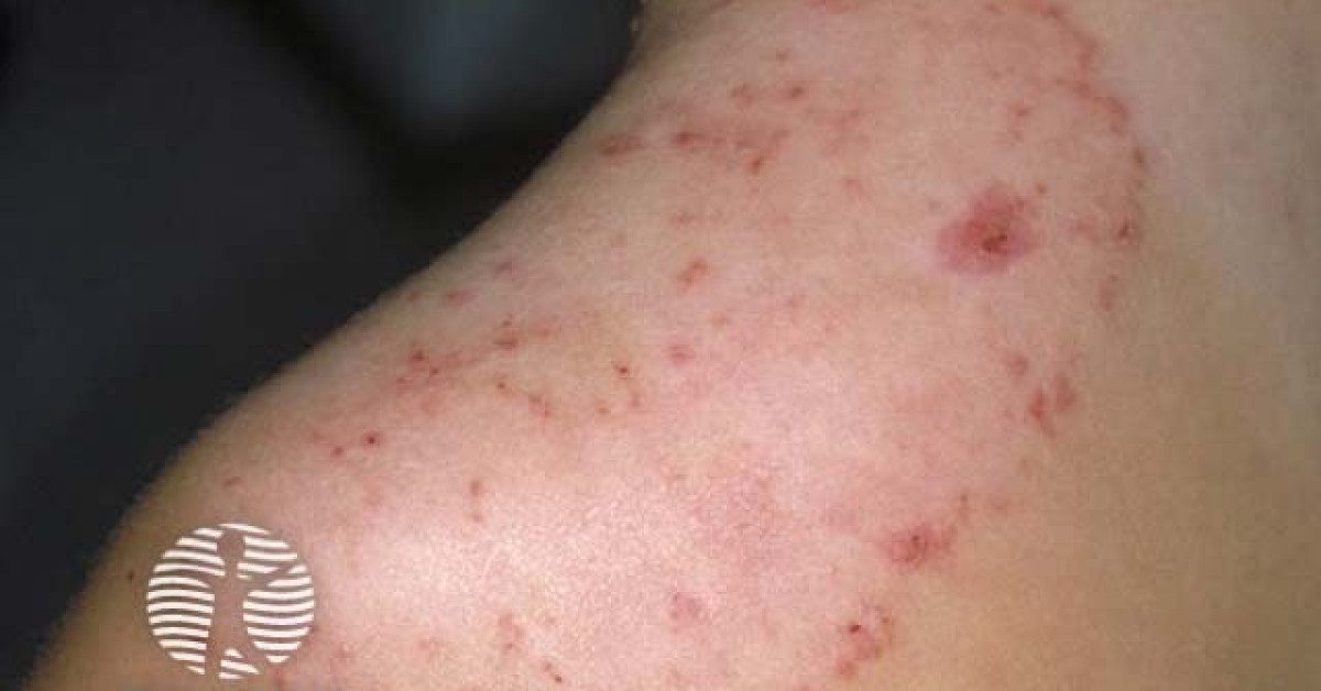 Tinea corporis image