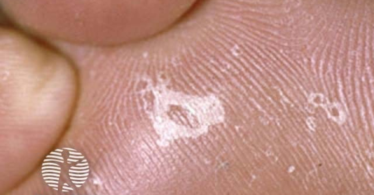Tinea pedis image