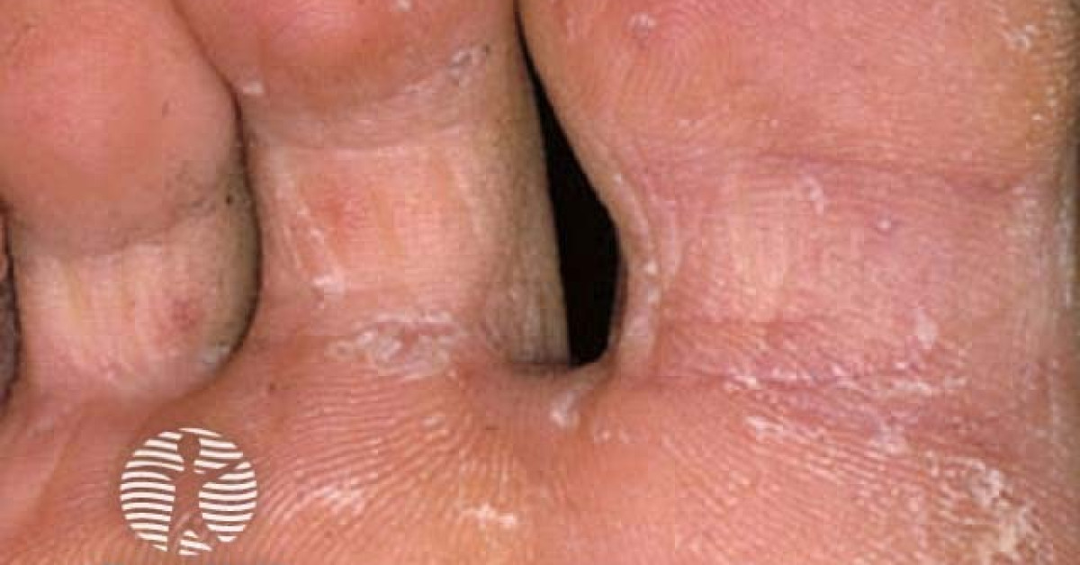 Tinea pedis image