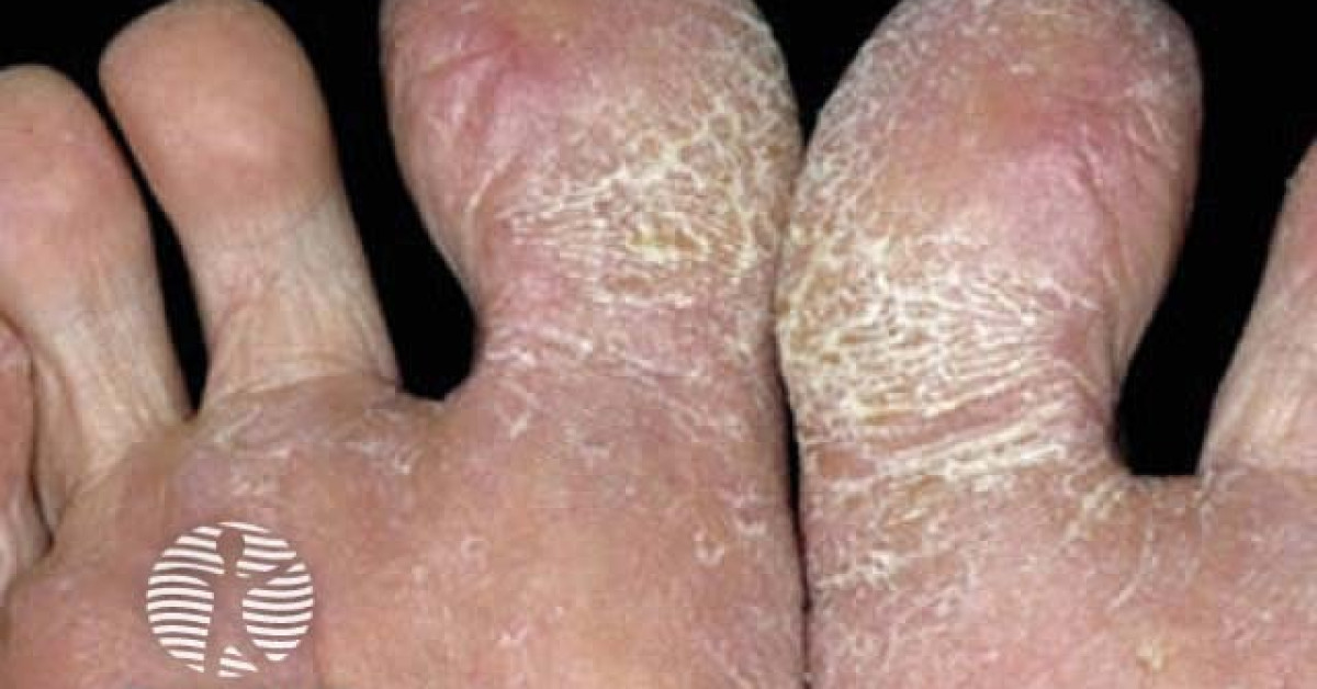 Tinea pedis image