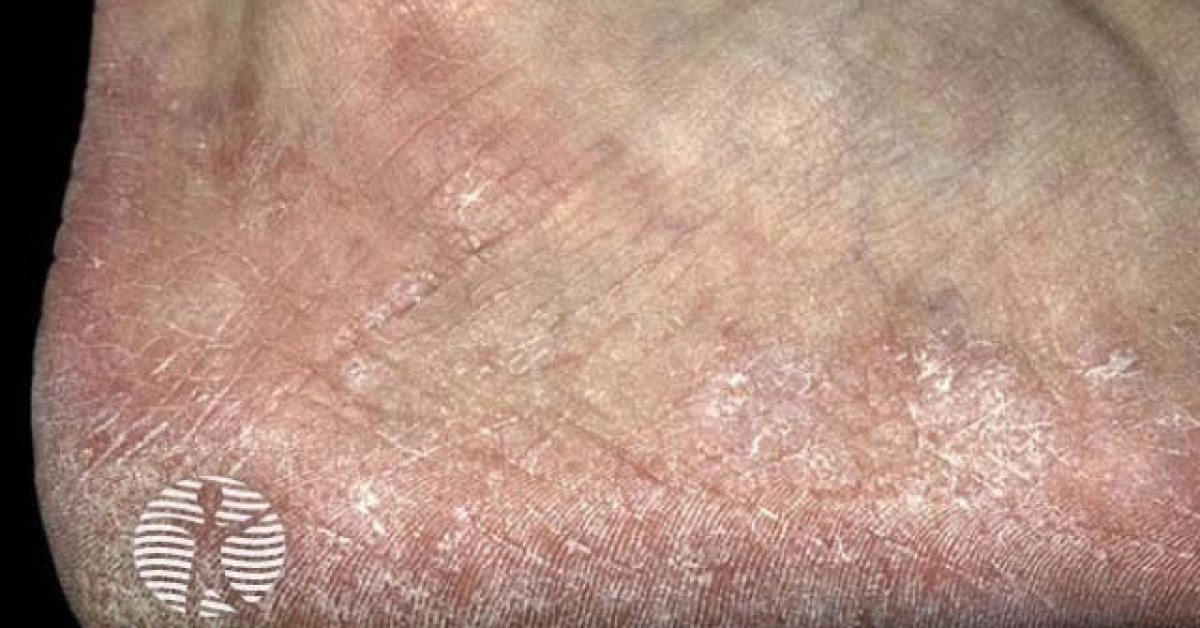 Tinea pedis image