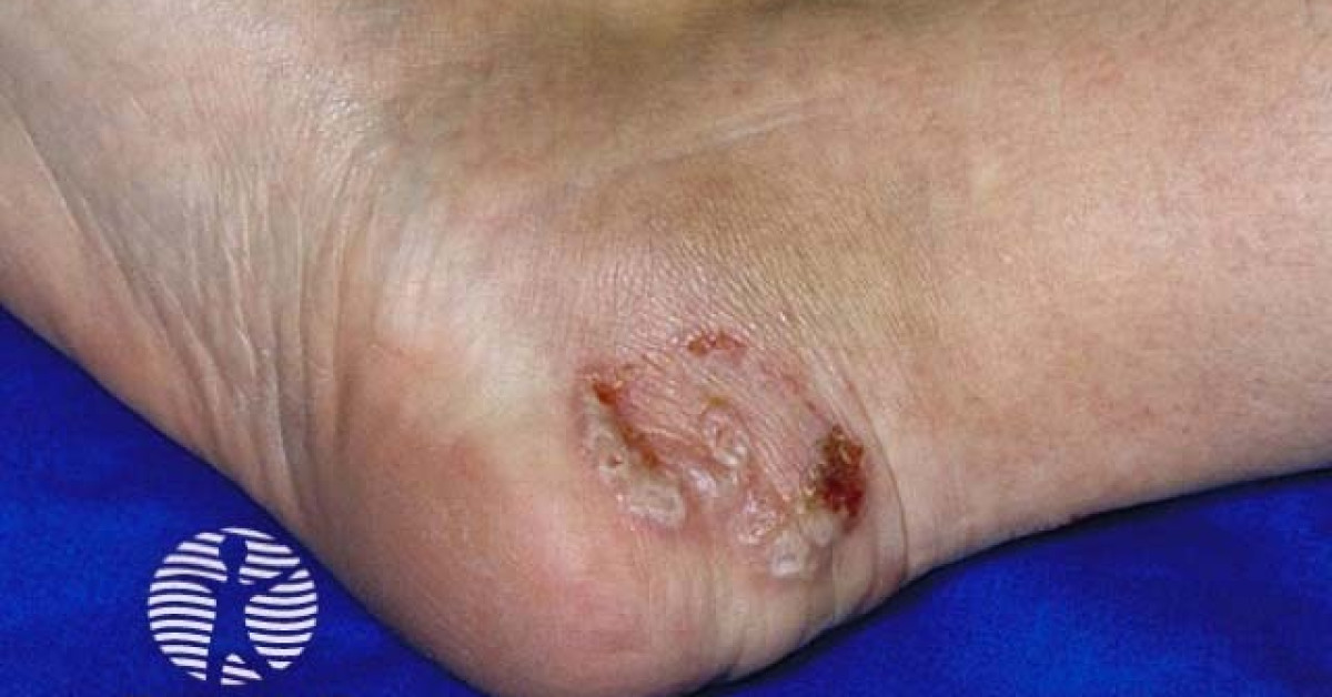 Tinea pedis image