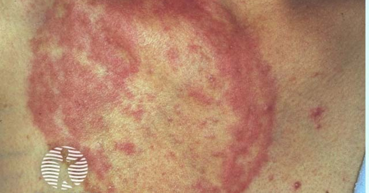 DermNet® - tinea corporis image