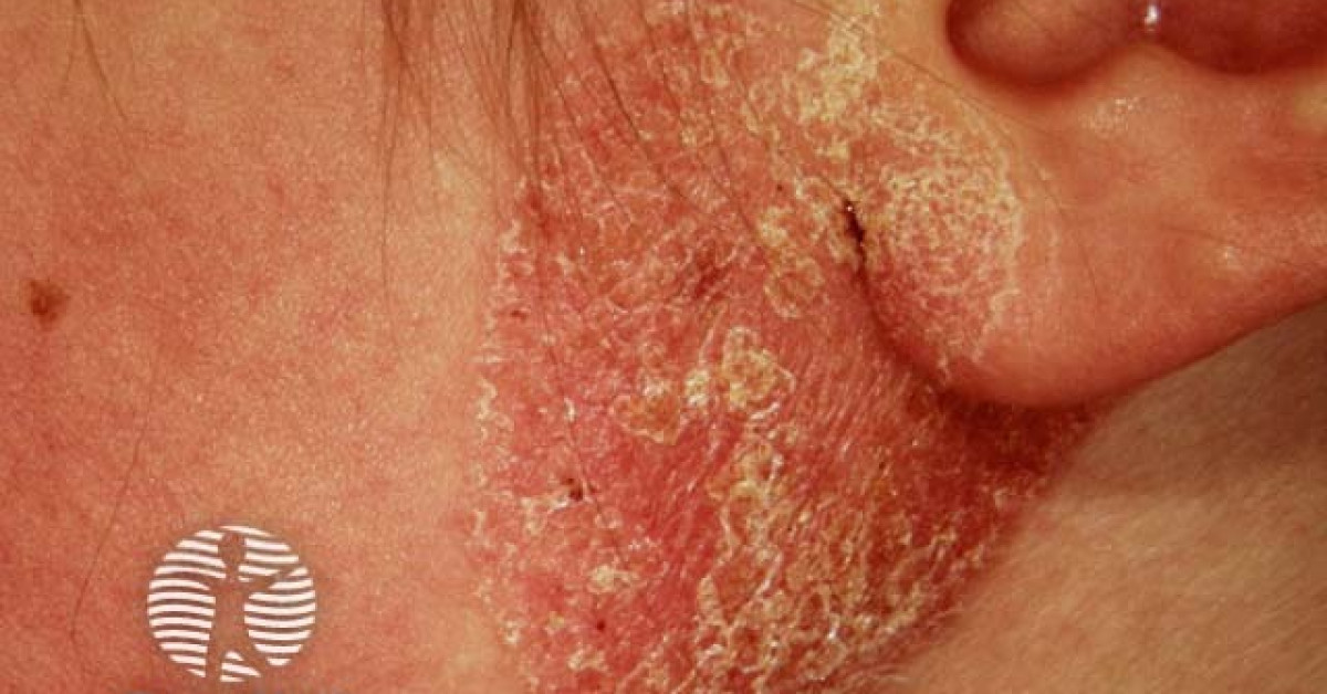 tinea faciei image