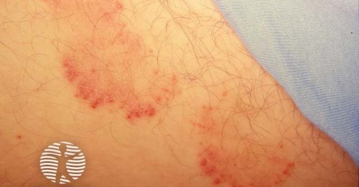Tinea cruris image