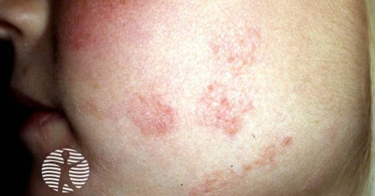 Tinea faciei image