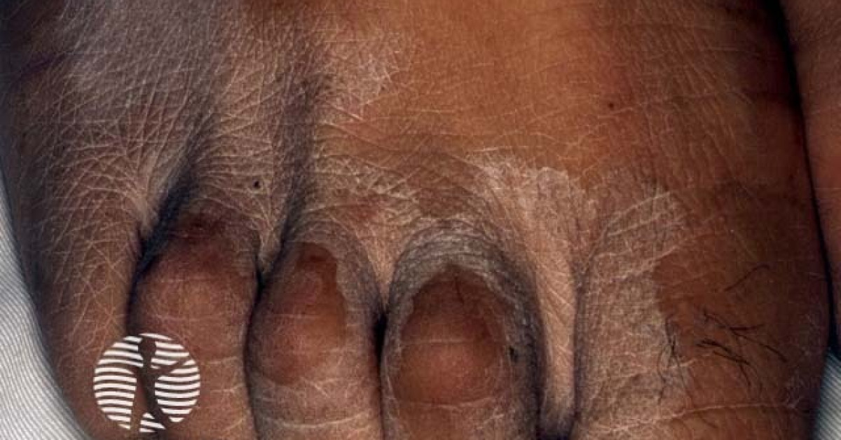 tinea incognito image