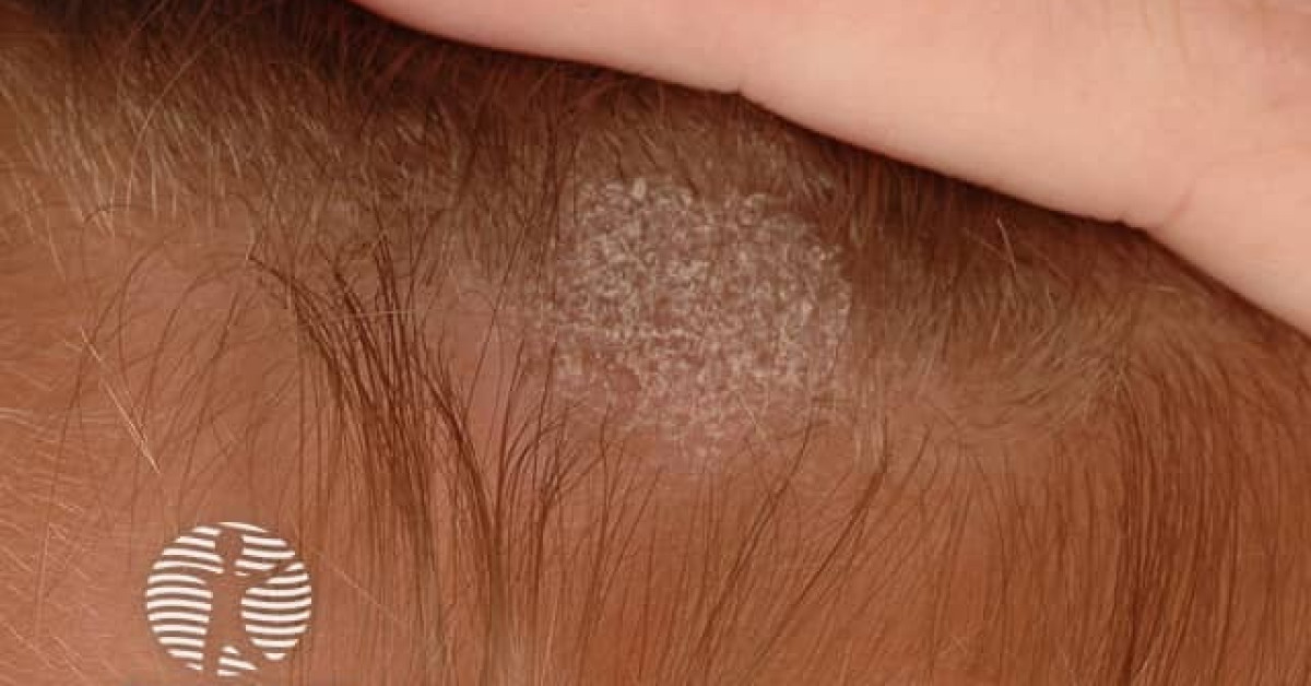 Tinea capitis image