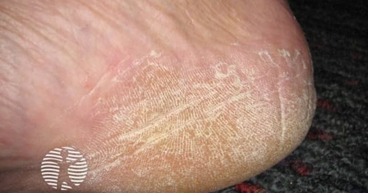 Tinea pedis image