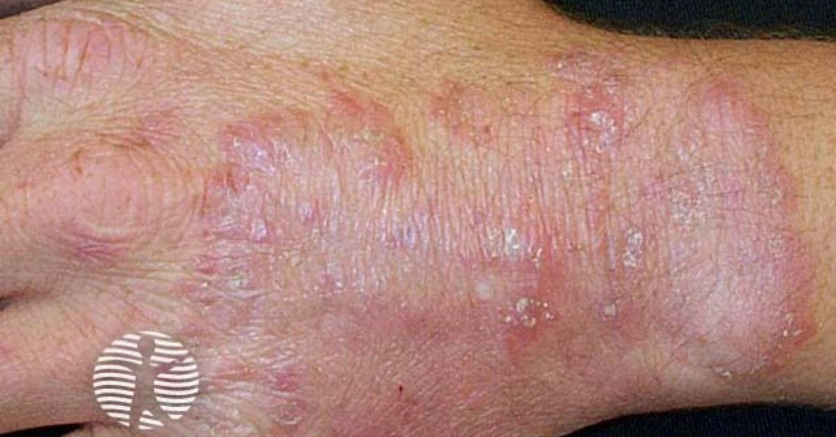 tinea manuum image