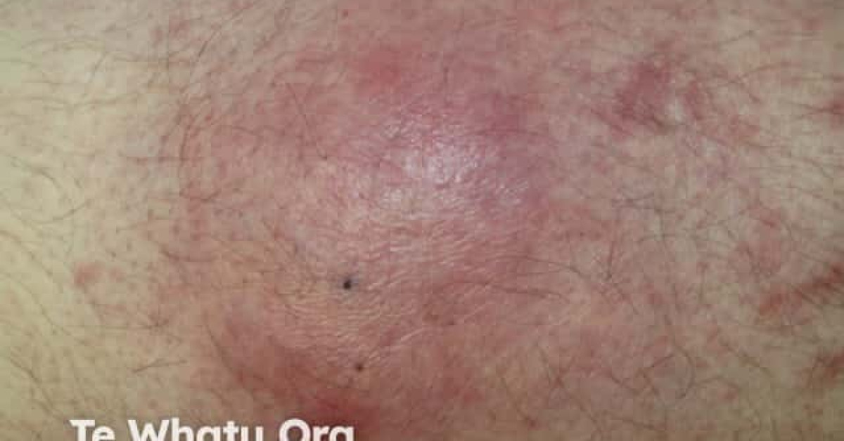 Cutaneous aspergillosis image