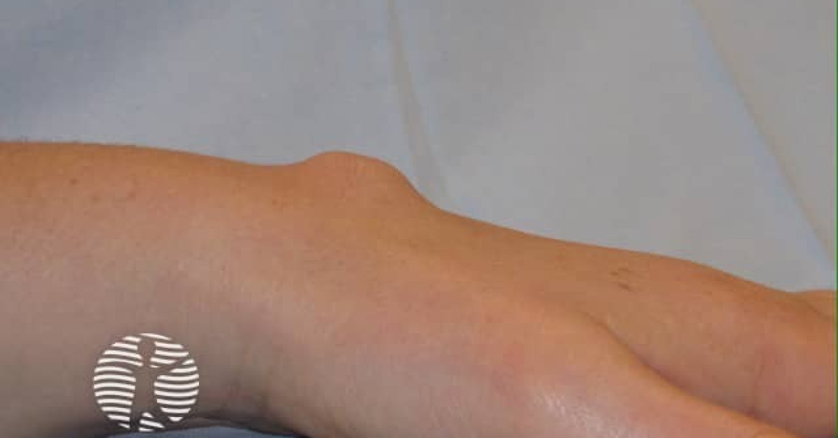 Ganglion cyst image