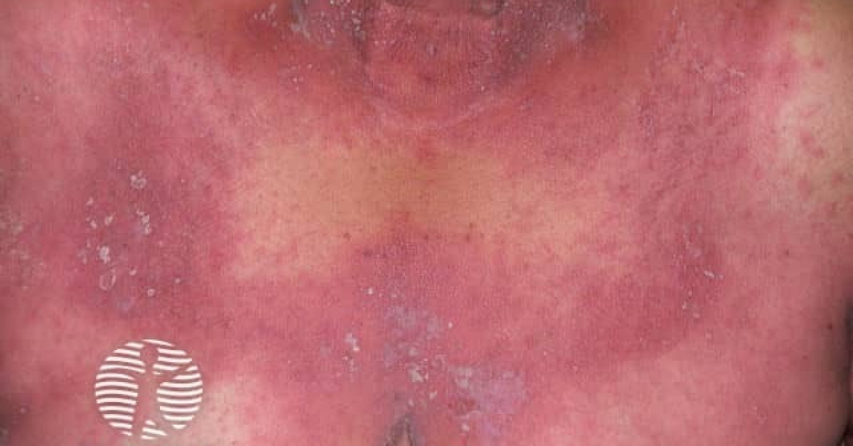 Generalised pustular psoriasis image
