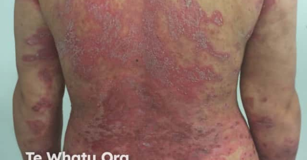 Generalised pustular psoriasis image