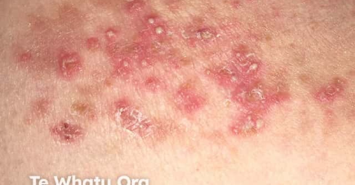 Generalised pustular psoriasis image