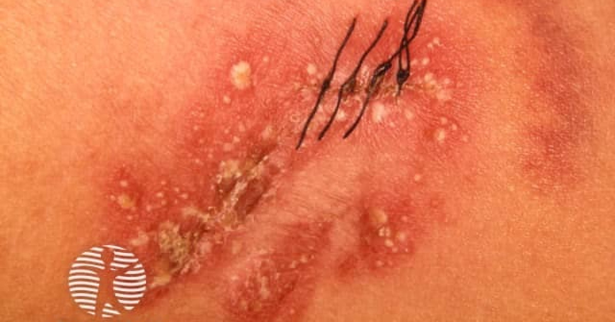 Generalised pustular psoriasis image