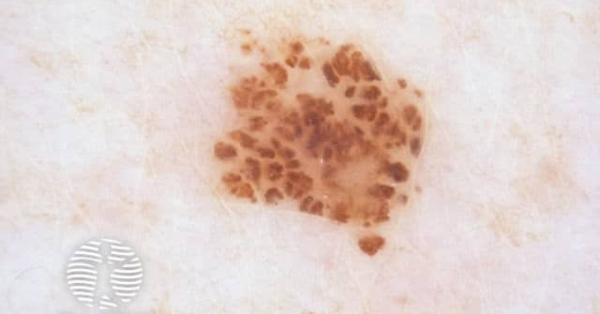 Globular naevus image