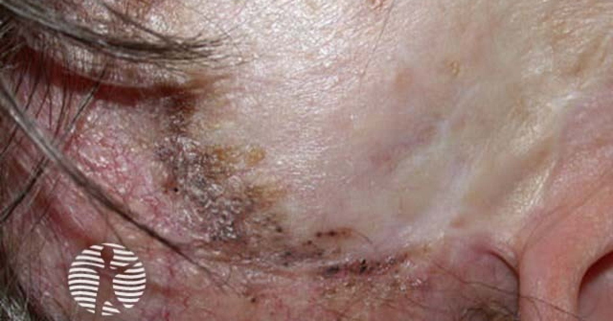 Recurrent Basal Cell Carcinoma Image