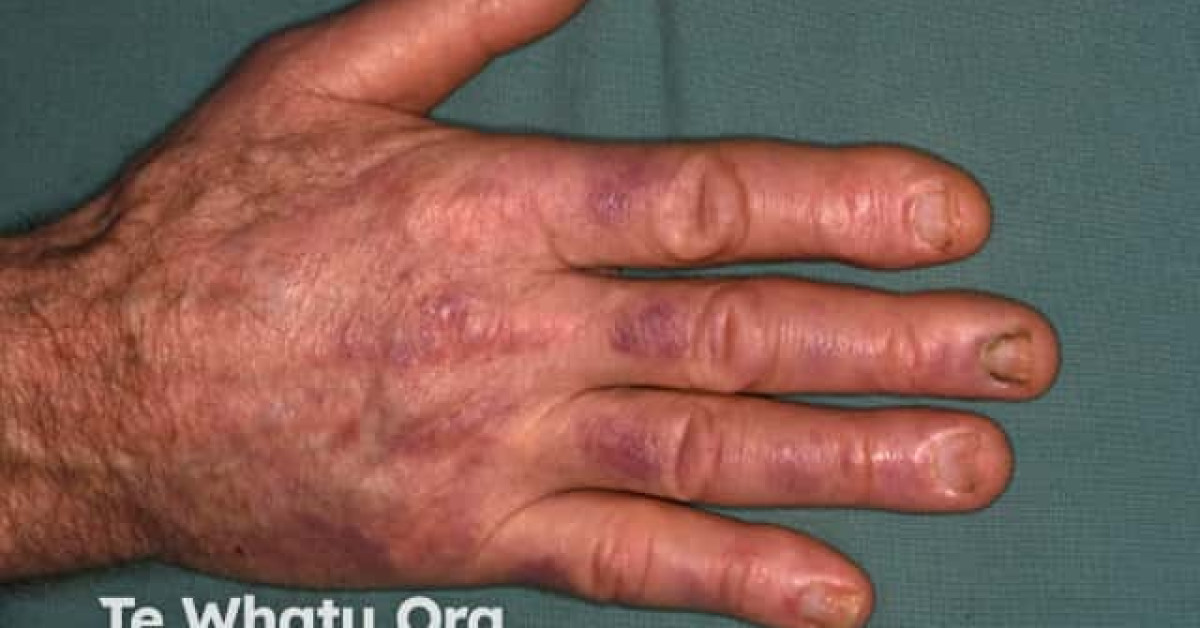 Gottron papules dermatomyositis image