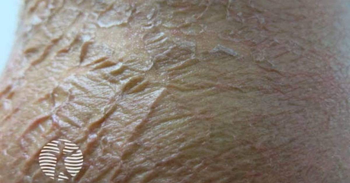 Granular parakeratosis image