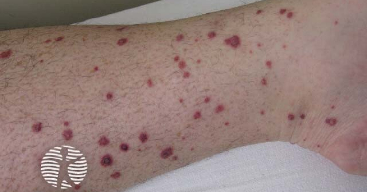 Hypersensitivity vasculitis in granulomatosis with polyangiitis image