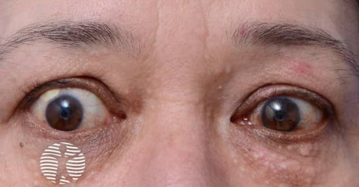 Graves disease: exophthalmos image