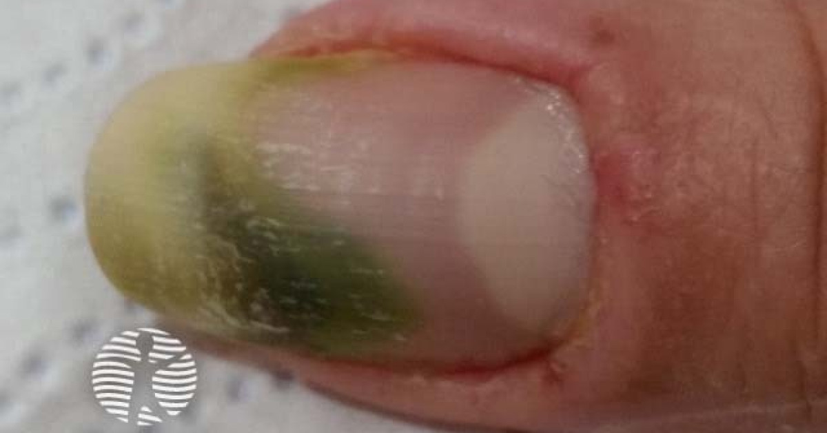 Green nail due to pseudomonas infection with paronychia image