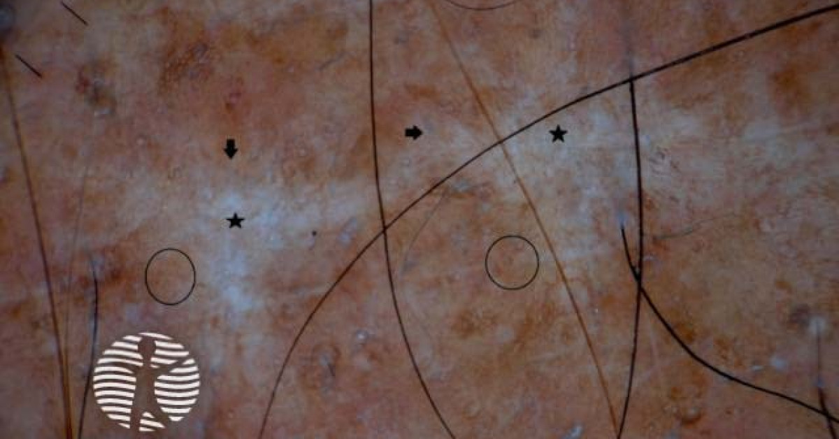 Idiopathic guttate hypomelanosis image