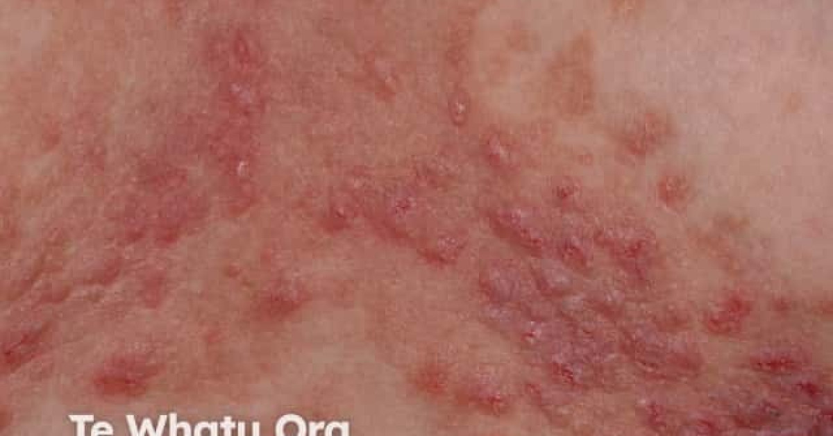 Hailey Hailey disease of chest image