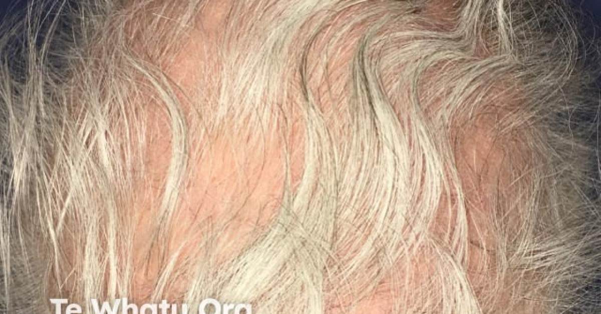 Diffuse hair loss image